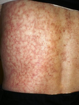 Doctors Warn of 'Toasted Skin' from Prolonged Laptop Use | PCWorld